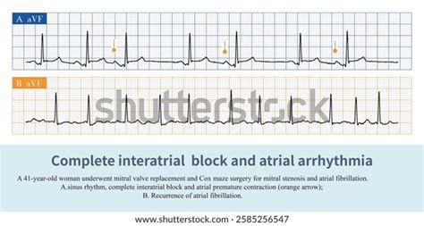 Complete Interatrial Block Over 10 Royalty Free Licensable Stock Illustrations And Drawings Complete Interatrial Block Over 10 Royalty Free Licensable Stock Illustrations And Drawings