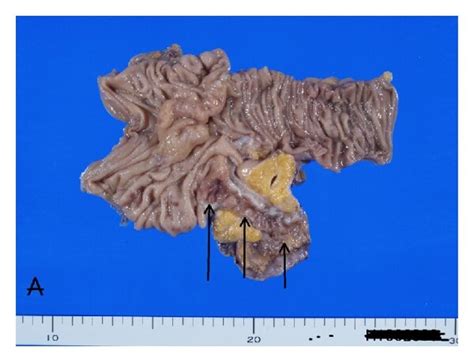 Gross Features Of The Appendiceal Tumor A The Appendix Arrow Is Download Scientific