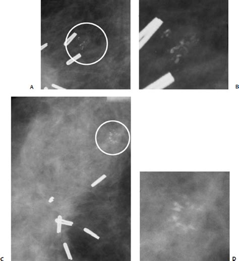 Calcifications Heterogeneous Pleomorphic Microcalcifications