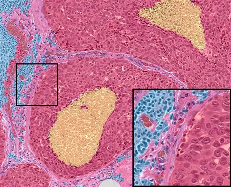 Pathology Slides Cancer