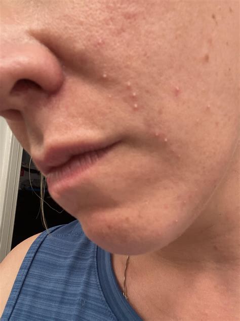 What Can I Do About Congested Skin My Skincare Routine Is Decent But I Cant Figure Out What Is