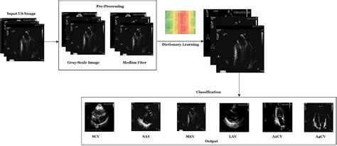 Echocardiographic Cardiac Views Classification Using Whale Optimization