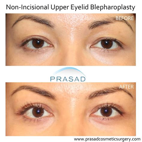 Double Eyelid Surgery Before And After Photos Dr Amiya Prasad