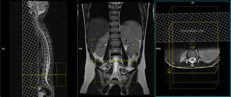 Mri Pediatric Spine Mri Pediatric Whole Spine Protocol And Planning