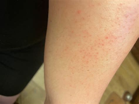 Красные точки на плечах Вопрос дерматологу 03 Онлайн