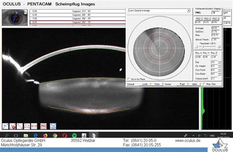 Lens Density Measurement Using Pentacam Oculus Three Dimensional Mode