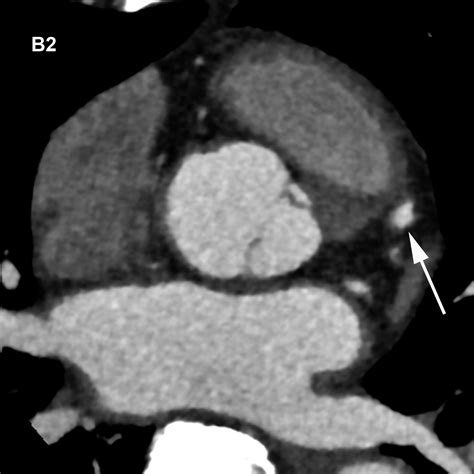 The Feasibility Of Forward Projected Model Based Iterative Reconstruction Solution First For
