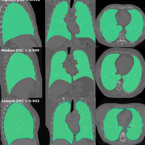 comparison of lung segmentations between lungct and vida diagnostics