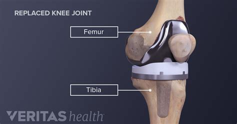 The Pros And Cons Of Double Knee Replacement