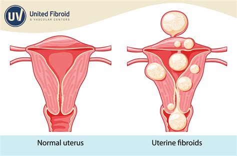 Uterine Fibroids What Are They Uterine Fibroids Dont Always Like To