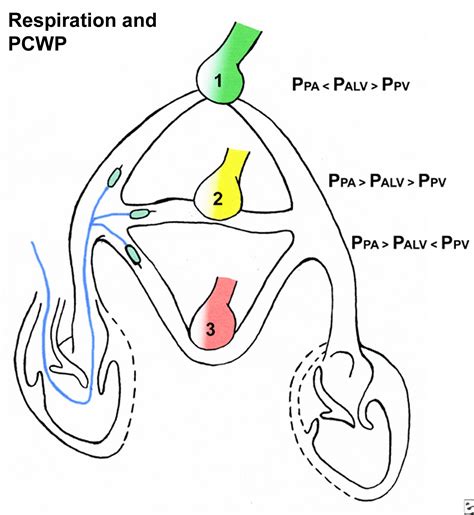 Pulmonary Wedge Pressure Pulmonary Artery Wedge Pressure Pulmonary