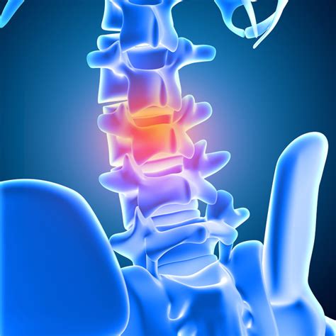 Percutaneous Disc Decompression Maywell Health