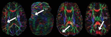 DTI Quality Control Part Further Reading Diffusion Imaging Introduction Tutorials And