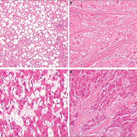 prkar1a expression in fibrolamellar carcinomas a the fibrolamellar