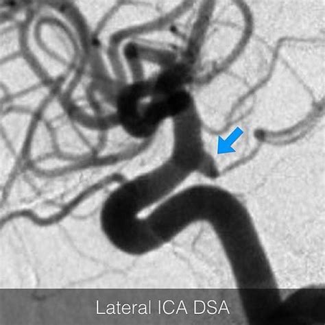 This Is A Pcom Infundibulum And Not An Aneurysm You Can T… Flickr