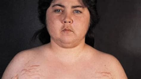 Qué Es El Síndrome De Cushing La Enfermedad Que Te Pone La Cara De Luna Llena” Infobae