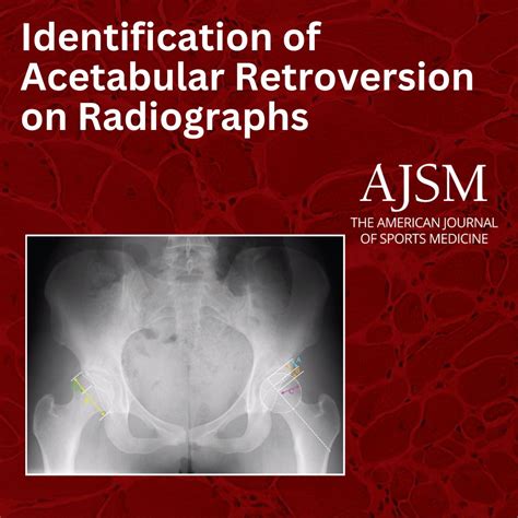 Identification Of Acetabular Retroversion On Radiographs Ow Ly Ftl750tuve5 Aossm Journals