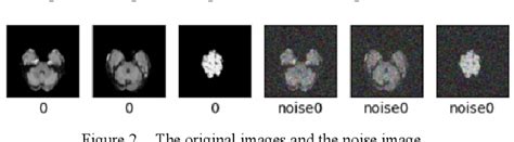 Figure 2 From A New Cnn Based Joint Network For Brain Tumor Denoising