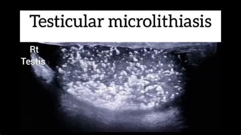 Microlithiasis In A 32 Year Old Man Daniel Ben Mordechay Posted On The Topic Linkedin