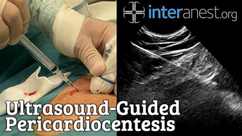 Ultrasound Guided Pericardiocentesis Youtube