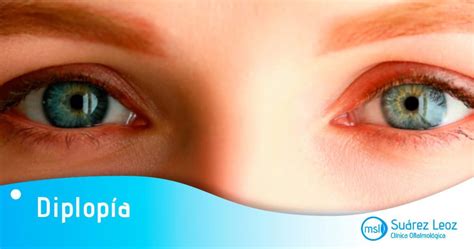 ¿qué Es La Diplopía Clínica Suarez Leoz