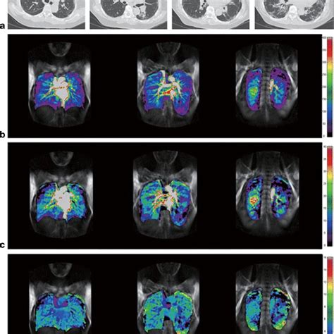Female 73 Year Old With Scleroderma Thin Section Ct Demonstrates Download Scientific Diagram