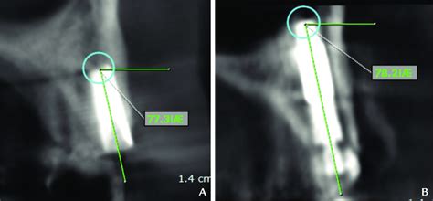 Superimposition Of Preoperative And Postoperative Cone Beam Computed Download Scientific