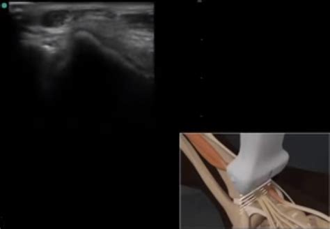 Foot And Ankle Extensor Digitorum Longus Transducer Position Image