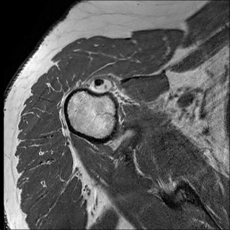 Subcoracoid Impingement With Subscapularis Tendinosis