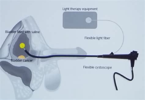Cuos 2019 Photodynamic Therapy For Bladder Cancer Results Of A Phase