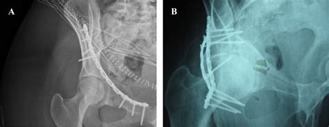 Surgical Treatment Of Acetabular Fractures Long Term Outcomes