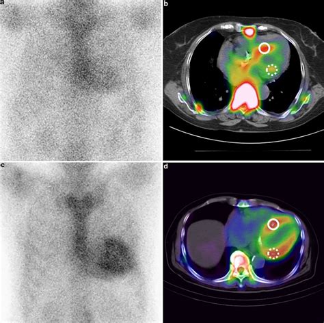 PYP Planar And SPECT CT Images Of Two ATTRwt CM Patients Circles Download Scientific Diagram