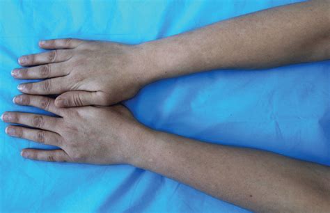 Multiple Hypopigmented Asymptomatic Macules On Both Hands And Forearms
