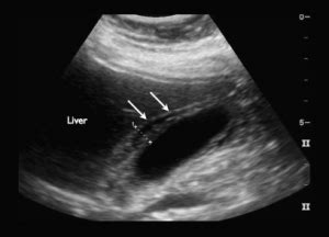 Acalculous Cholecystitis Wikem