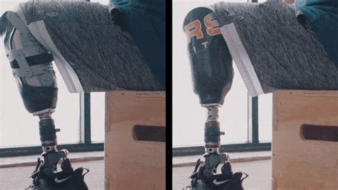 Below Knee And Symes Socket Less Socket™ — Martin Bionics