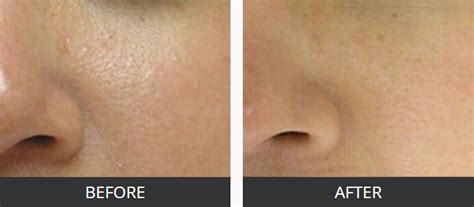 Gallery Northwest Vein And Aesthetic Center