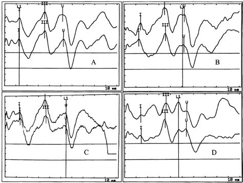 graphic visualization of wave latencies and inter peak intervals in