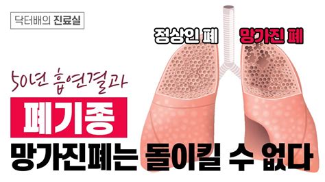 내과 질환 흡연의 결과는 돌이킬 수 없다 50년 간 흡연한 환자의 망가진 폐 폐기종 Youtube