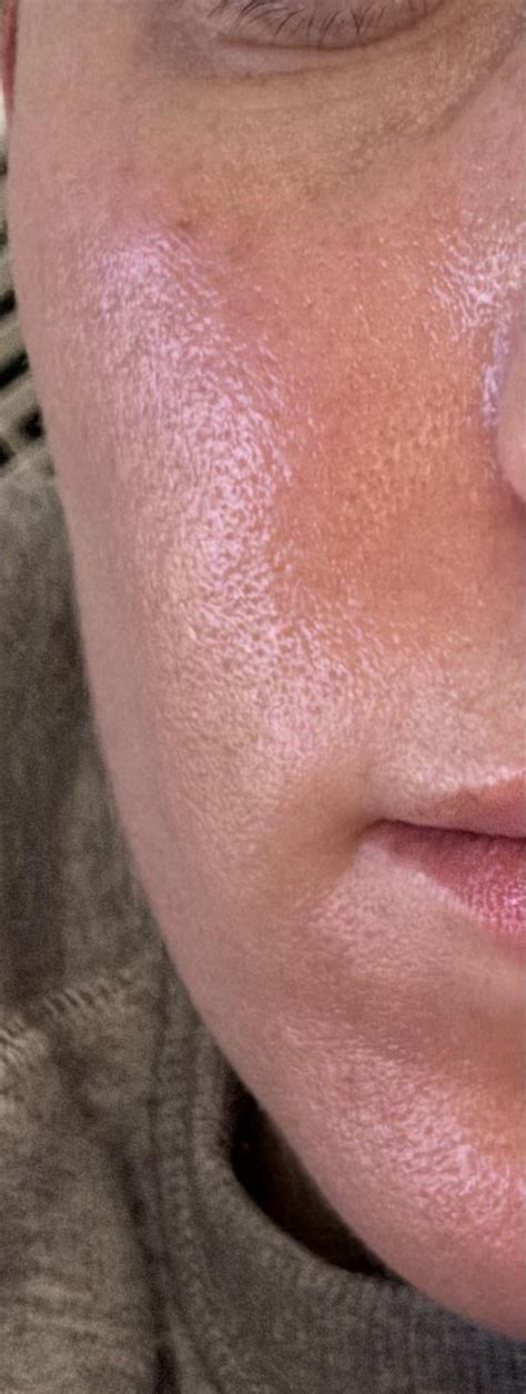 Rosacea Or Dehydrated Skin 1 Full Year Of This Skin Issue Rrosacea