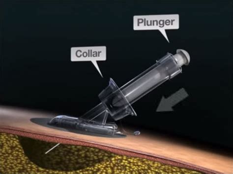 How Does A Dexcom Continuous Glucose Monitor Work Tipwiki FUDiabetes