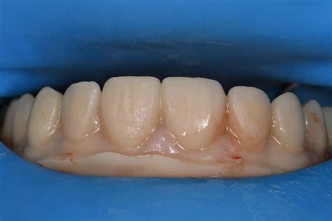 Kerr Optiview Indirect Re Preparations