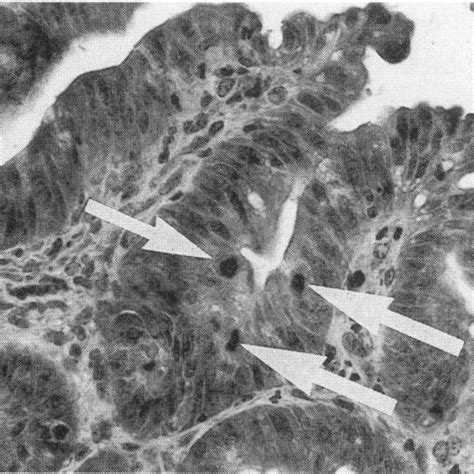 Severe Crypt Hyperplasia Imparting An Adenomatous Appearance With
