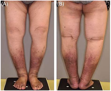 Elephantiasis Leg