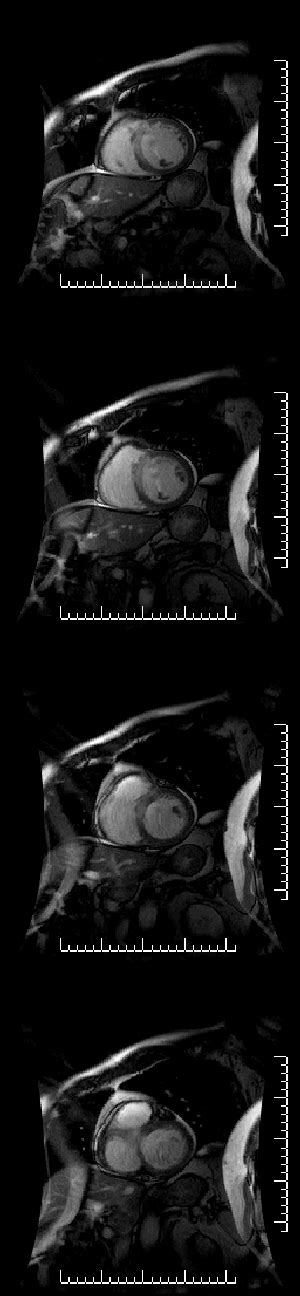 Mri Images Cardiac Infarct Short Axis Cine 5 Mr