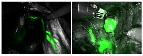 Fluorescent Indocyanine Green Versus Technetium 99m And Blue Dye For