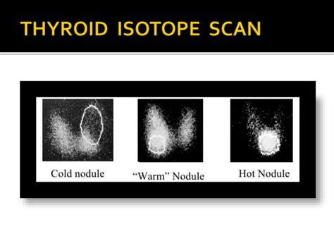 Clinically Discrete Swellings Of Thyroid Gland Pptx Thyroid