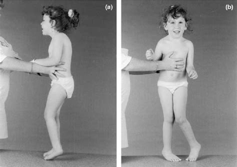 Figure 2 From Classiﬁcation Of Gait Patterns In Spastic Hemiplegia And Spastic Diplegia A Basis