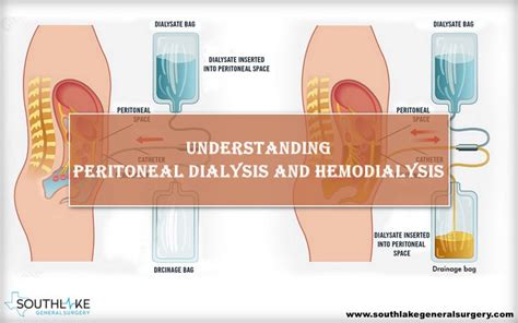 Peritoneal Dialysis Vs Hemodialysis Rlaparoscopy