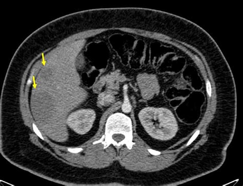 Axial Abdomen And Pelvis Ct Scan Showing Hepatic Hypodense Lesion And