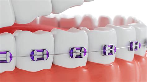 흰색 배경에 고립 된 명확한 흰색 치아에 치열 교정 브래킷과 화장품 치과 클리핑 부품 3d 렌더링 치아교정기에 대한 스톡 사진 및 기타 이미지 Istock